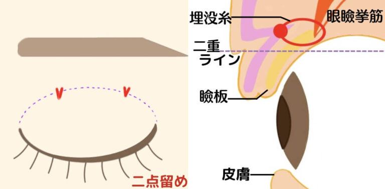 二重埋没法 - ラクレクリニック
